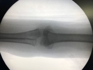 Treatment of a transcondylar fracture of the right ulnar bone with ...