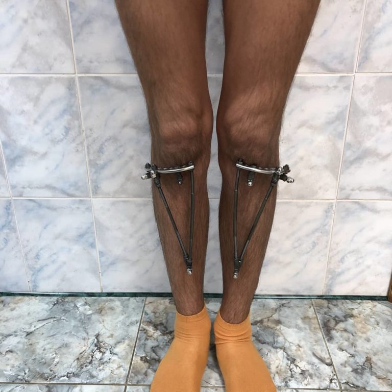 Varus deformity (bow legs): symptoms, diagnostics, treatment blog Ladisten