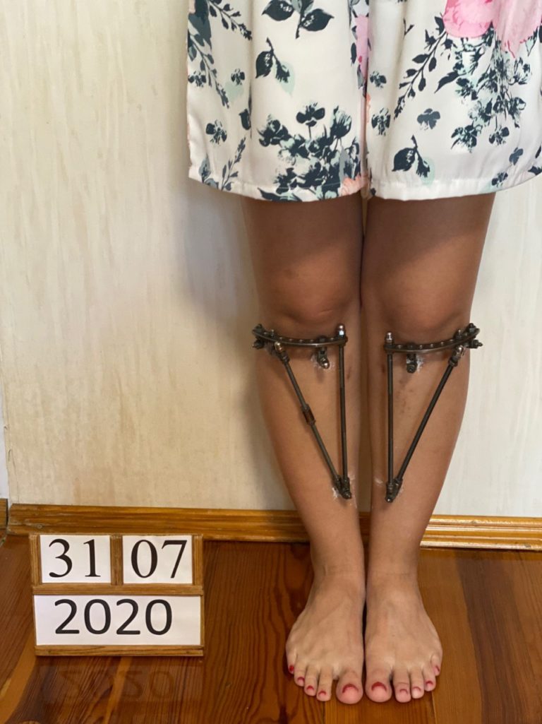 Varus deformity (bow legs): symptoms, diagnostics, treatment blog Ladisten