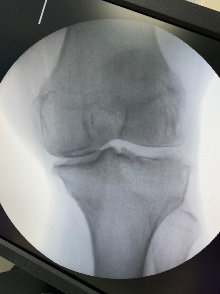 The result of the treatment of arthrosis of the knee joints – Ladisten
