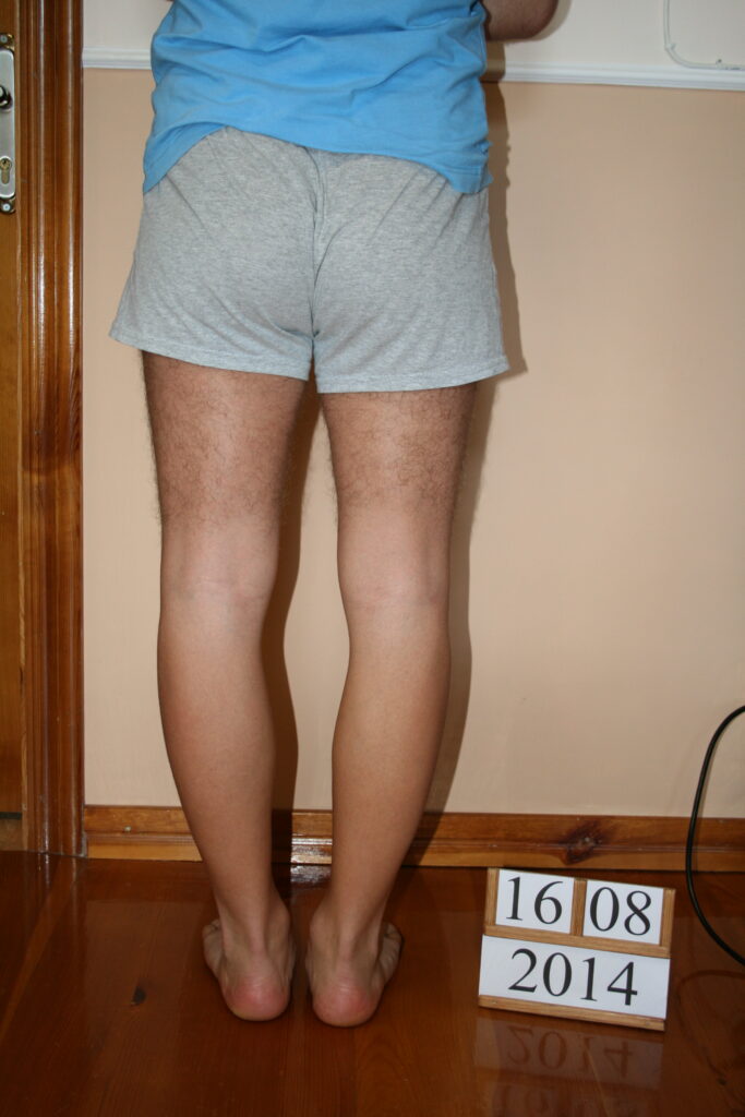 Varus deformity of both legs ᐉ Ladisten