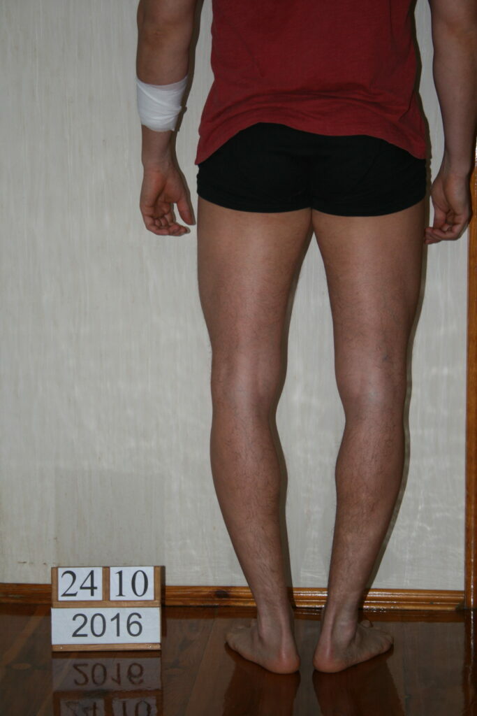 Genu varum ᐉ Ladisten